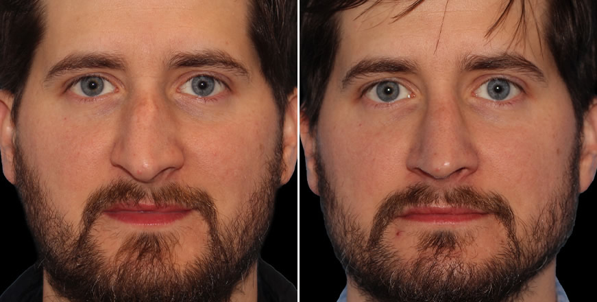 Scarless Rhinoplasty Atlanta | No Scar Rhinoplasty